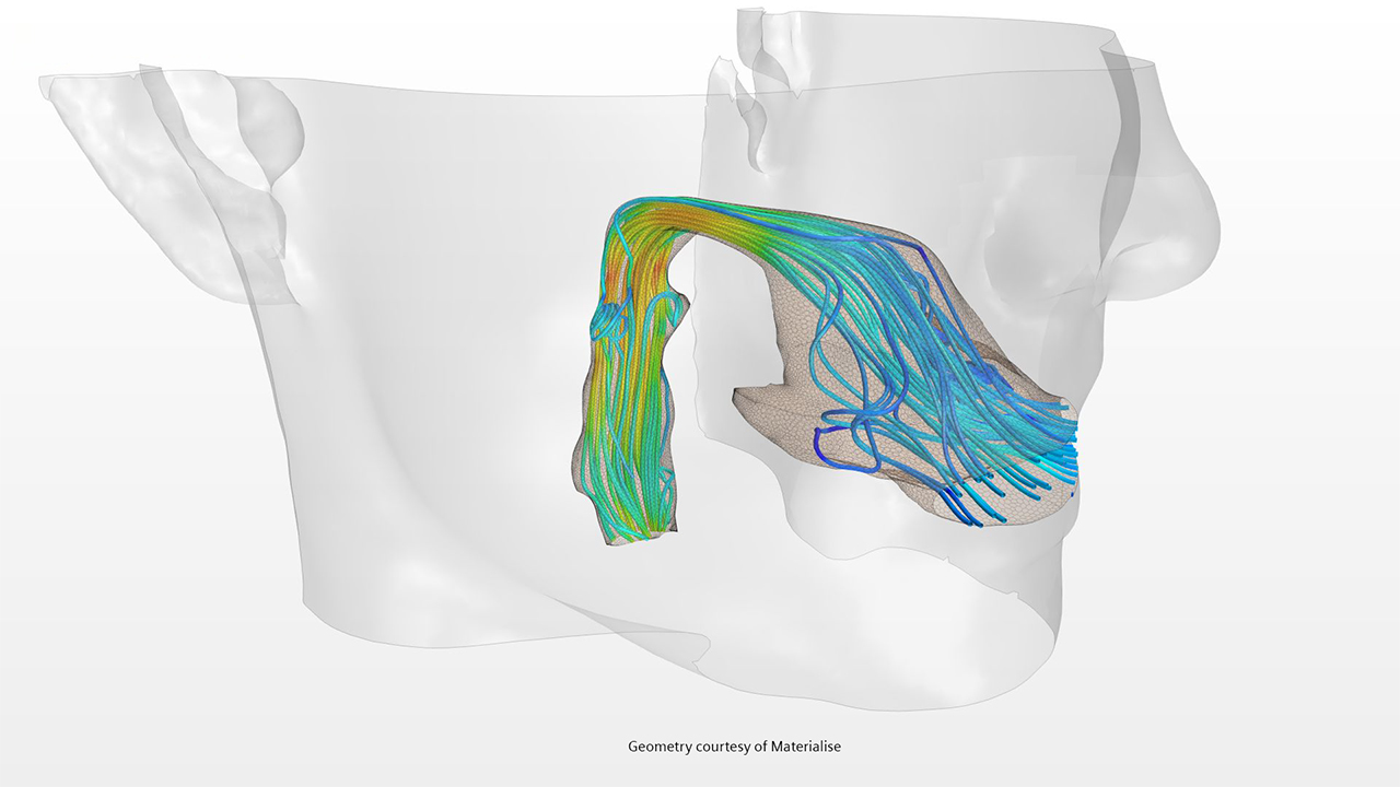CFD simulation of Respiratory Drug Delivery | Siemens Software CFD simulation of Respiratory Drug Delivery | Siemens Software